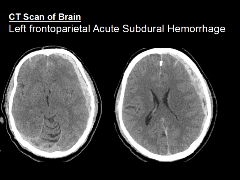 Head injuries - Dr Goutham Cugati
