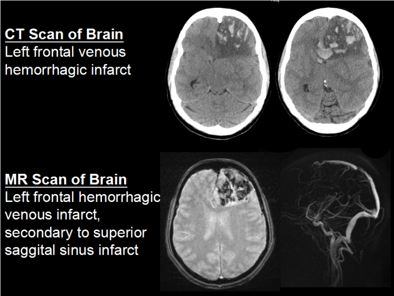 Cerebrovascular pathologies - Dr Goutham Cugati