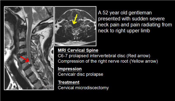 Cervical disc prolapse - Dr Goutham Cugati