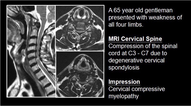 Cervical Spondylosis - Dr Goutham Cugati