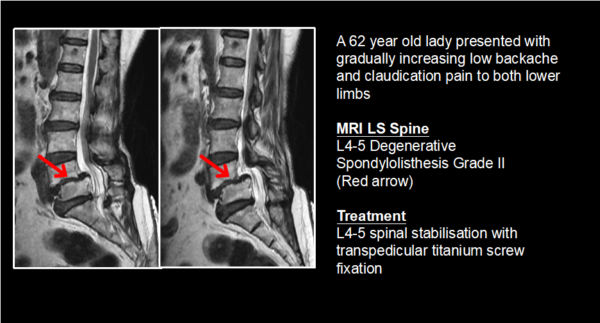 Lumbar Spondylolisthesis - Dr Goutham Cugati