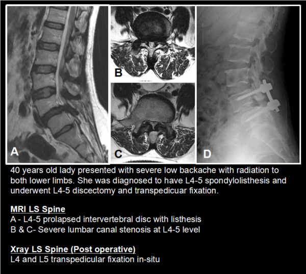 Lumbar Spondylolisthesis - Dr Goutham Cugati