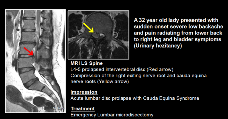 Lumbar Disc Prolapse - Dr Goutham Cugati